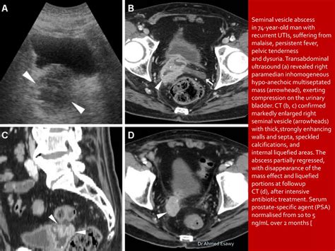 Imaging Vastitis Differentitis Funiculitis Seminal Vesiculitis Dr Ahmed