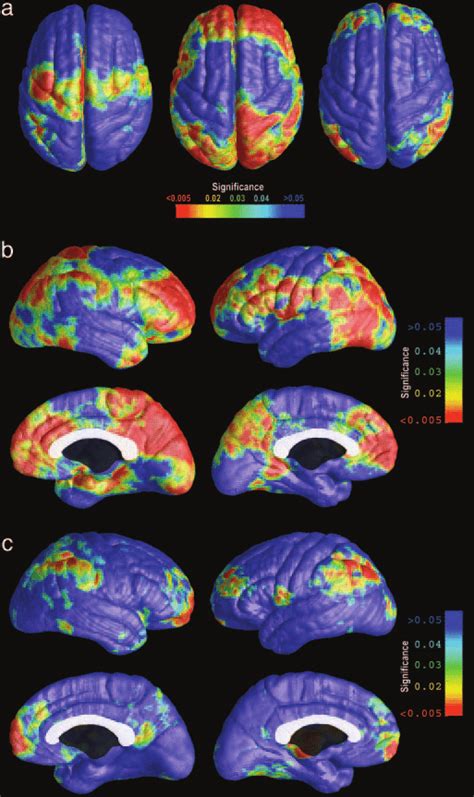 Cortical Thinning Is Associated With Cognitive Impairment And Immune