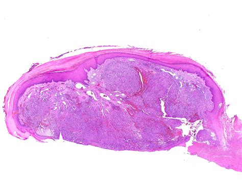 Nodular Kaposi Sarcoma