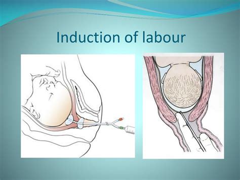 Ppt Induction Of Labor Powerpoint Presentation Free Download Id