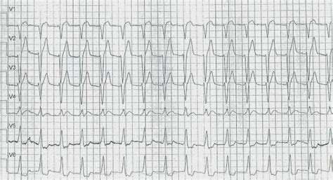 Dr Smith S ECG Blog Is This Left Bundle Branch Block Is There STEMI