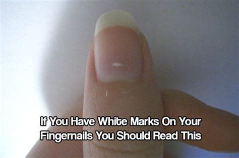 If You Have White Marks On Your Fingernails You Should Read This Shtf