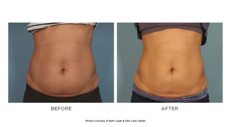 Coolsculpting® Elite Before And After Photos Behr Laser And Skin Care Center