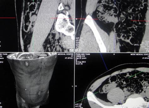 Vietnamese Medic Ultrasound Case 137 Appendix Tumor Dr Phan Thanh