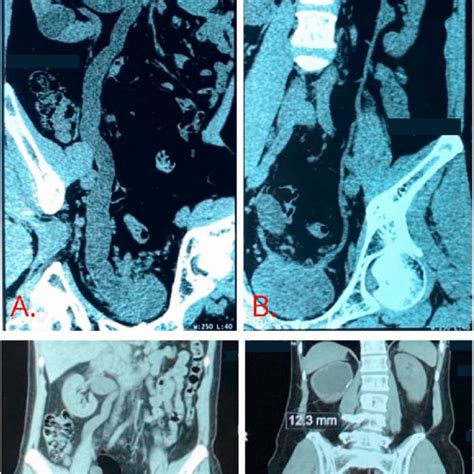 Ab Retrograde Pyelogram From The Right Ureter Orifice At The Bladder