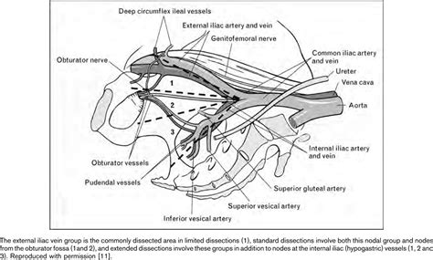 Pelvic Node Dissection In Prostate Cancer Extended Limited