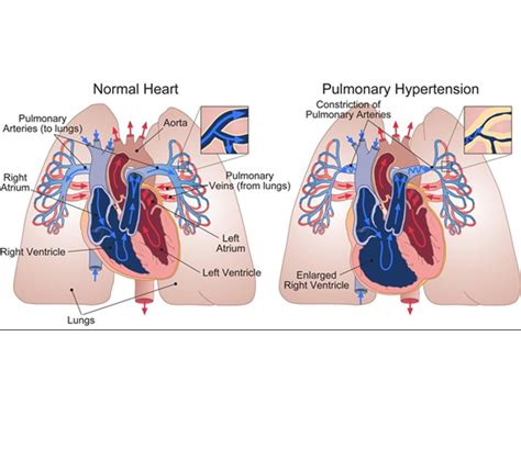 Pulmonary Arterial Hypertension St Michaels Medical Cntr