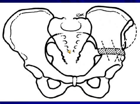 Perthes Disease Leggcalveperthes Disease Coxa Plana Professorayman Soliman