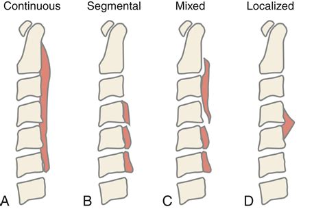 Ossification Of The Posterior Longitudinal Ligament Clinical Tree