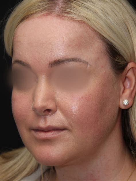 Dr Philip Solomon Facial Plastic Surgeon In Toronto