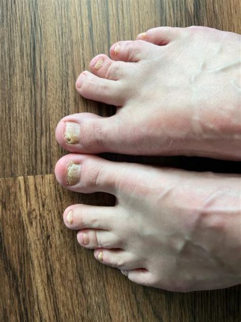 Before My Three Month Course Of Terbinafine Rnailfungus