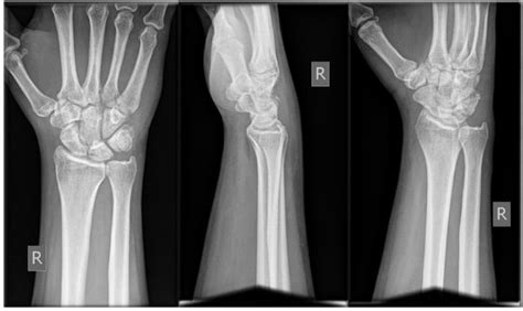 Triquetral Fracture Symptoms