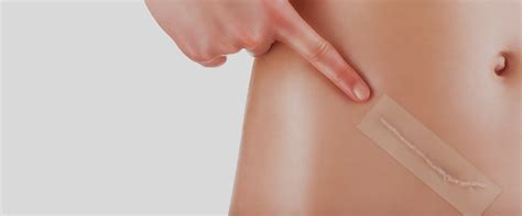 Oemodm Hodaf Silicone Scar Sheet Wholesale Manufacturer