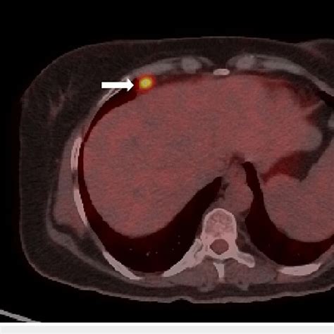 Initial Positron Emission Tomography Ct Revealed Conglomerated Download Scientific Diagram