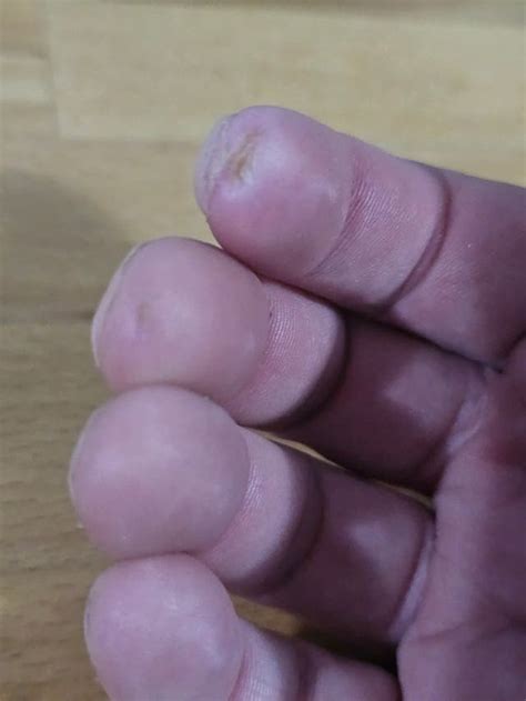 Scleroderma Dad Given Two Years To Live After Cold Fingers Turns Out
