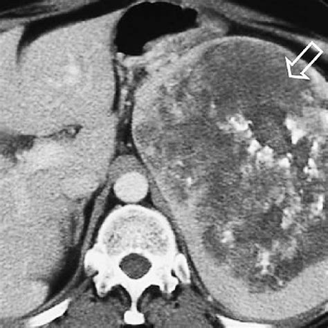 Ct Scan Demonstrating Retroperitoneal Lymph Node Involvement With Download Scientific Diagram