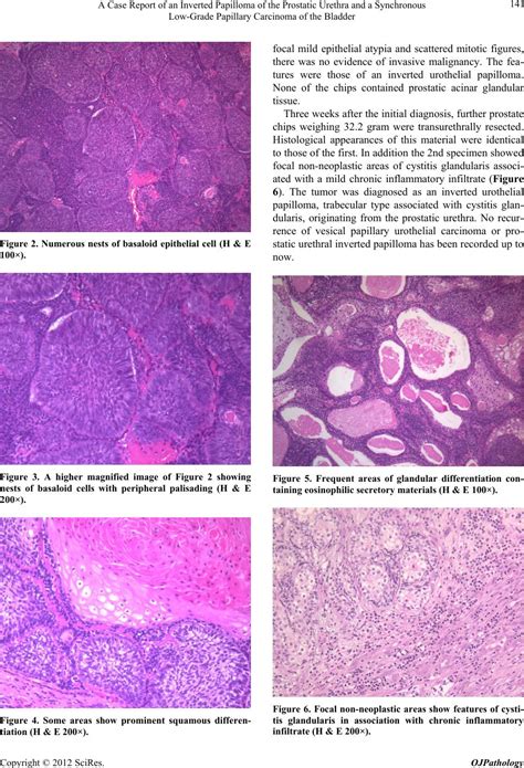 A Case Report Of An Inverted Papilloma Of The Prostatic Urethra And A Synchronous Low Grade