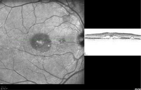 Rpe Detachments Right Eye Figure 6 Rpe Detachment Left Eye Download