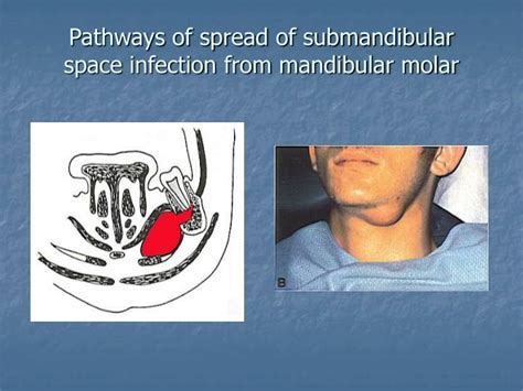 Ppt Diagnosis And Management Of Acute Infections Powerpoint