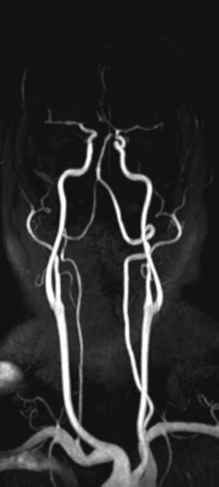Dose Reduction In Contrast Enhanced Cervical Mr Angiography Field