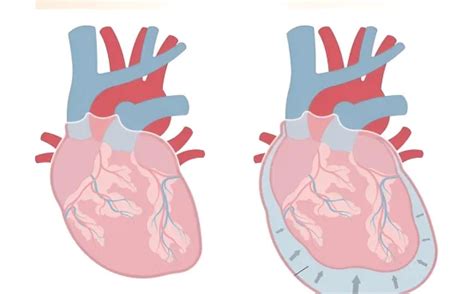 Types Of Pericardiectomy Surgery Medisuggest