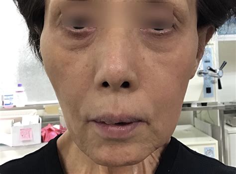目の下のたるみ取り＋糸リフト 熊本で安心・安全な美容整形を受けるならー共立美容外科熊本