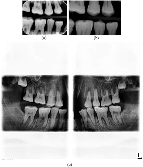 Examples Of Intraoral And Extraoral Bitewing Radiographs A Intraoral