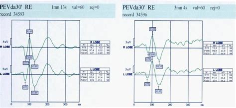 Normal Pvep 60 Pattern Reversal Stimulations Of Checks With Download Scientific Diagram