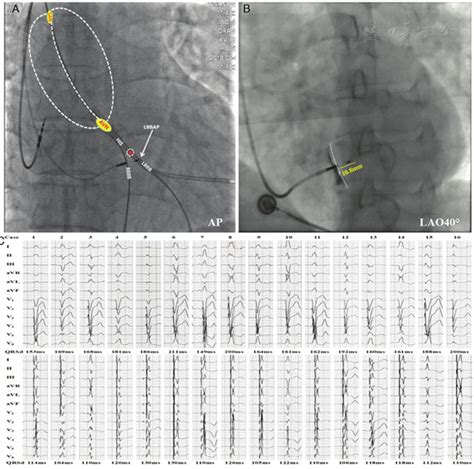 Effects Of Permanent Left Bundle Branch Area Pacing On QRS Duration And