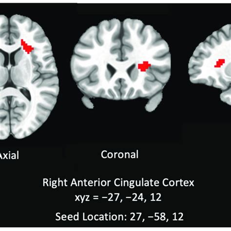 Group Analysis Of Connectivity Within The Dorsal Attention Network Of Download Scientific