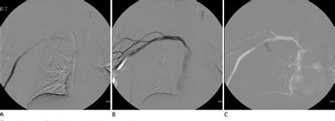 Table 1 From Venogram Of The Upper Extremity Using The Tourniquet