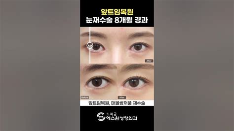 에스원성형외과 앞트임복원 매몰쌍꺼풀 재수술 8개월 경과 앞트임복원 앞트임재수술 앞트임재건 앞트임실패 앞트임복원후기