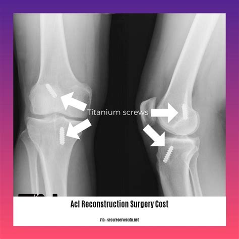 Acl Reconstruction Surgery Cost A Comprehensive Guide To