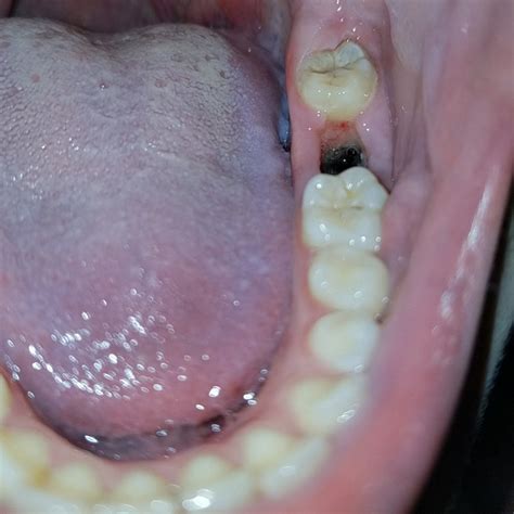 Tooth Extraction Good Healing