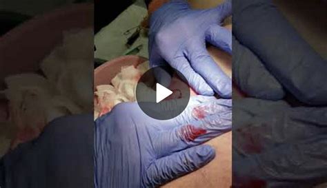 Spider Bite Infection On Woman Turned Into Abscess R Blackhead