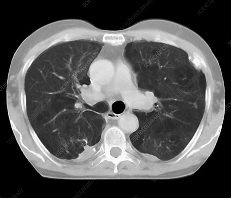 Emphysema Stock Image M150 0241 Science Photo Library
