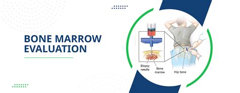 Bone Marrow Evaluation Dr Rakesh Patil