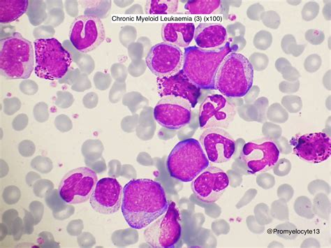 CML HaemBase