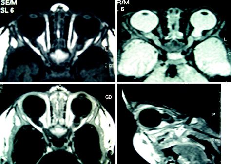 Peripapillary Staphyloma Peripapillary Staphyloma