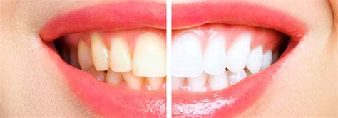 Mira Clinic Emax Veneers Pros And Cons