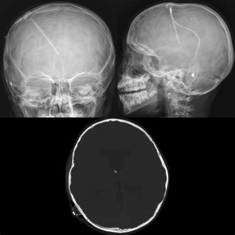 School Ager With Long Standing Headaches Who Just Had A Vp Shunt Placed