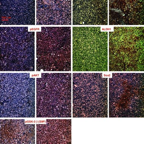 expression of versican promoted breast cancer cell tumor formation and