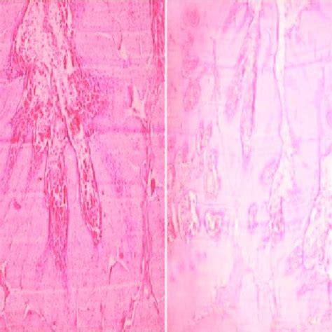 Sections Showing Hyperplastic Squamous Epithelium Along With
