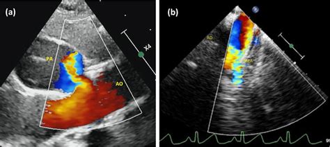 A Parasternal Long Axis Of The Aorta With Cranial Tilt To Visualize