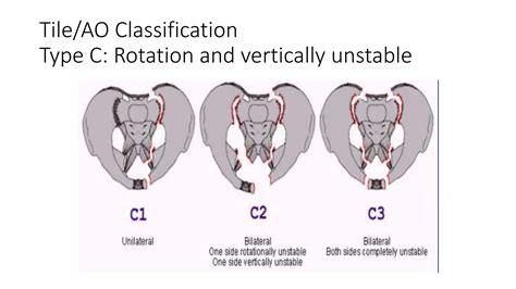 A Lecture On Pelvic Fractures Part 1pptx