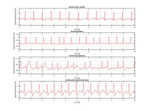 A Samples Of Used Ecg Signal Fragments Download Scientific Diagram