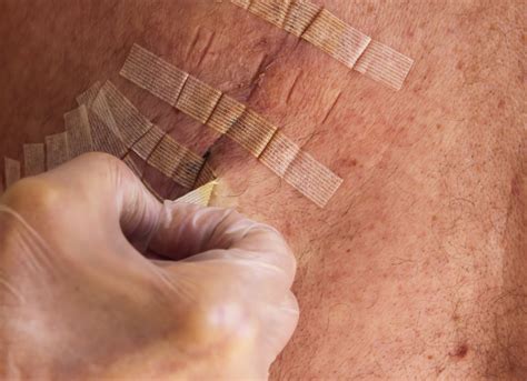 When And How To Use 3m Steri Strips For Different Types Of Wounds