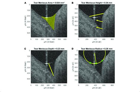 Assessment Of Tear Meniscus Using Uhr Oct Automatic Segmentation Of