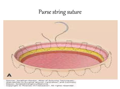 Ventricular Septal Defect Pptx Heart And Cardiovascular Diseases Diseases And Conditions