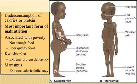 Malnutrition Ppt